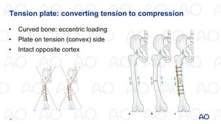 plates in fracture fixation on orthopedic | PPT