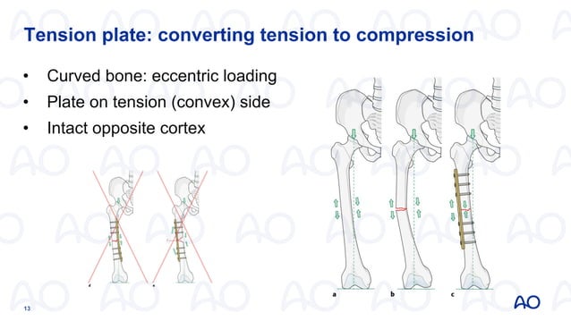 plates in fracture fixation on orthopedic | PPT