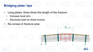 plates in fracture fixation on orthopedic | PPT