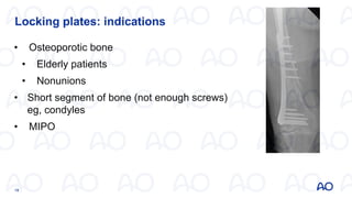 plates in fracture fixation on orthopedic | PPT