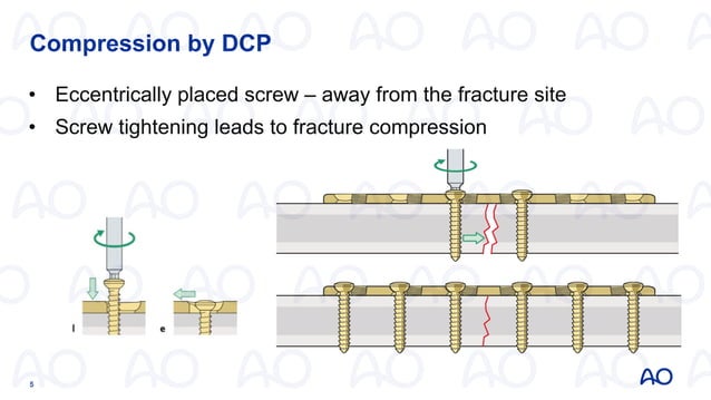 plates in fracture fixation on orthopedic | PPT