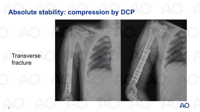 plates in fracture fixation on orthopedic | PPT