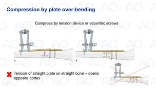 plates in fracture fixation on orthopedic | PPT