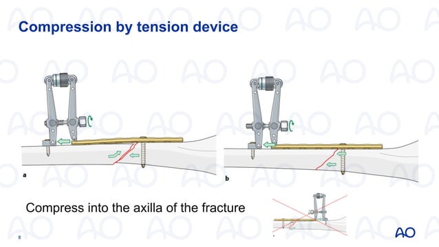 plates in fracture fixation on orthopedic | PPT