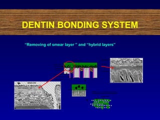 Prosedur Bonding pada material resin komposit | PPT