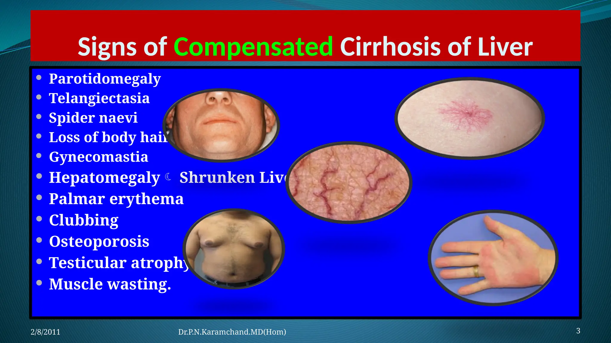 2.Liver cirrhosis & Signs and Symptoms of Cirrhosis | PPT