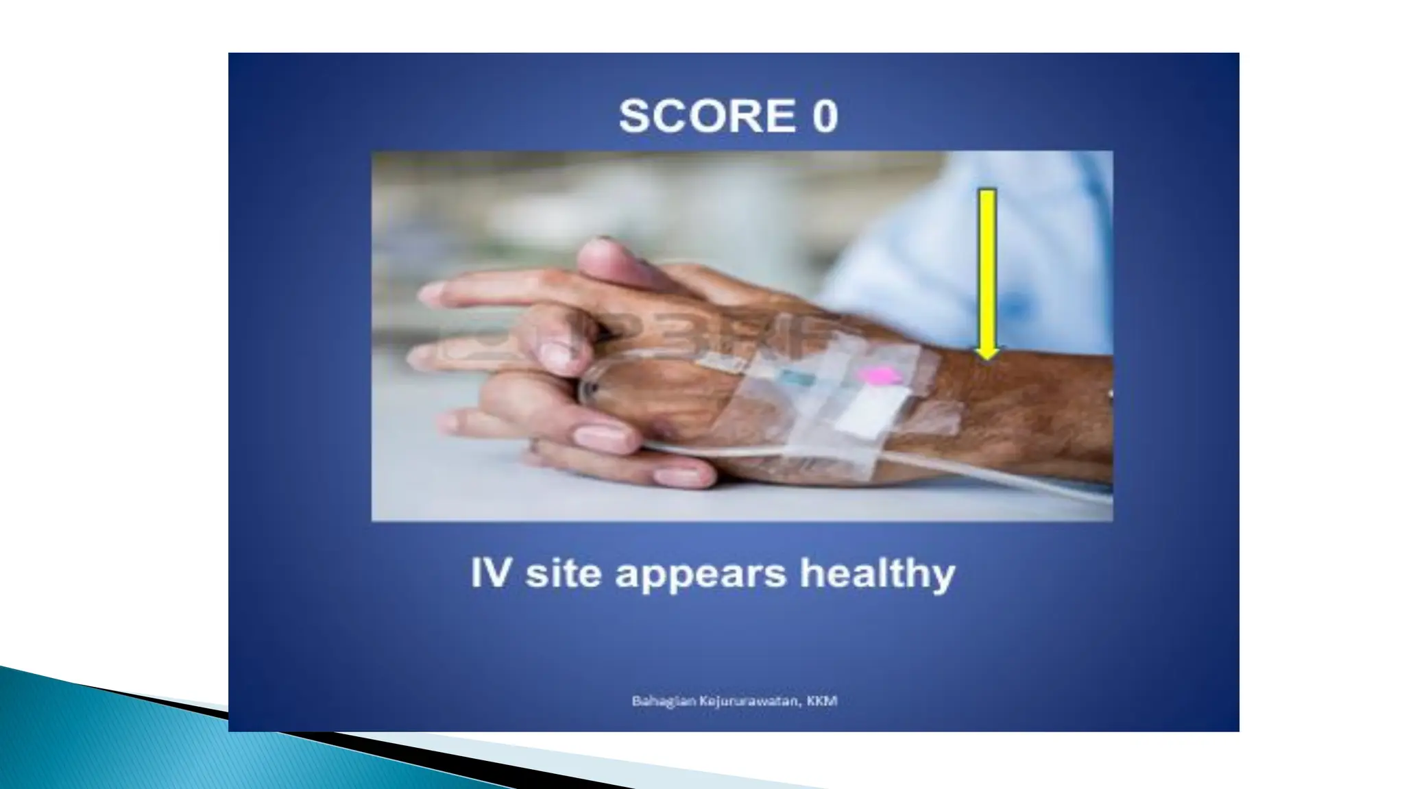 PHLEBITIS NEW INDICATOR FOR NURSES TEACHING SLIDE | PDF