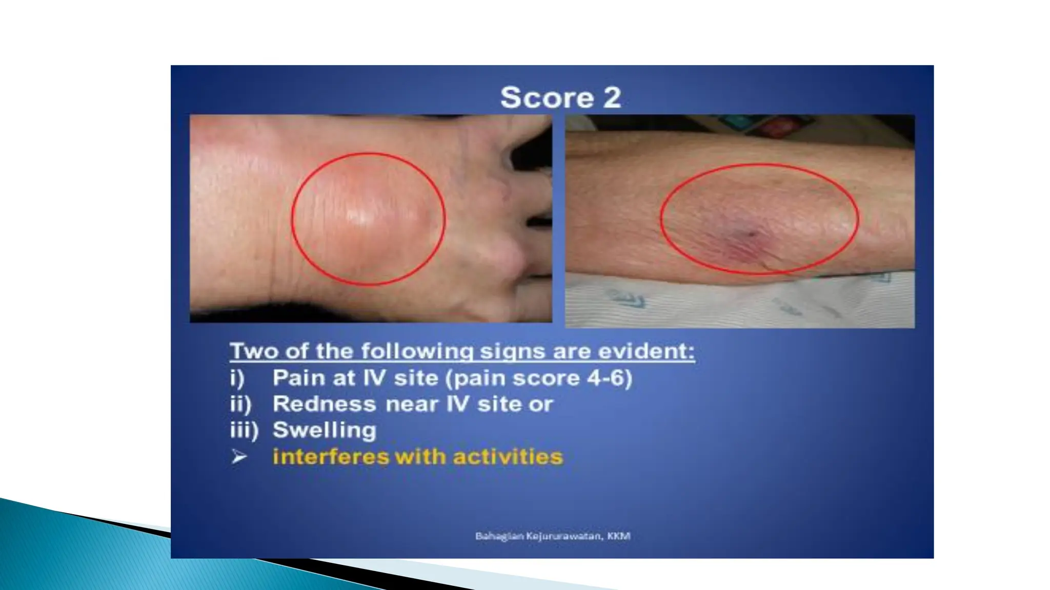 PHLEBITIS NEW INDICATOR FOR NURSES TEACHING SLIDE | PDF