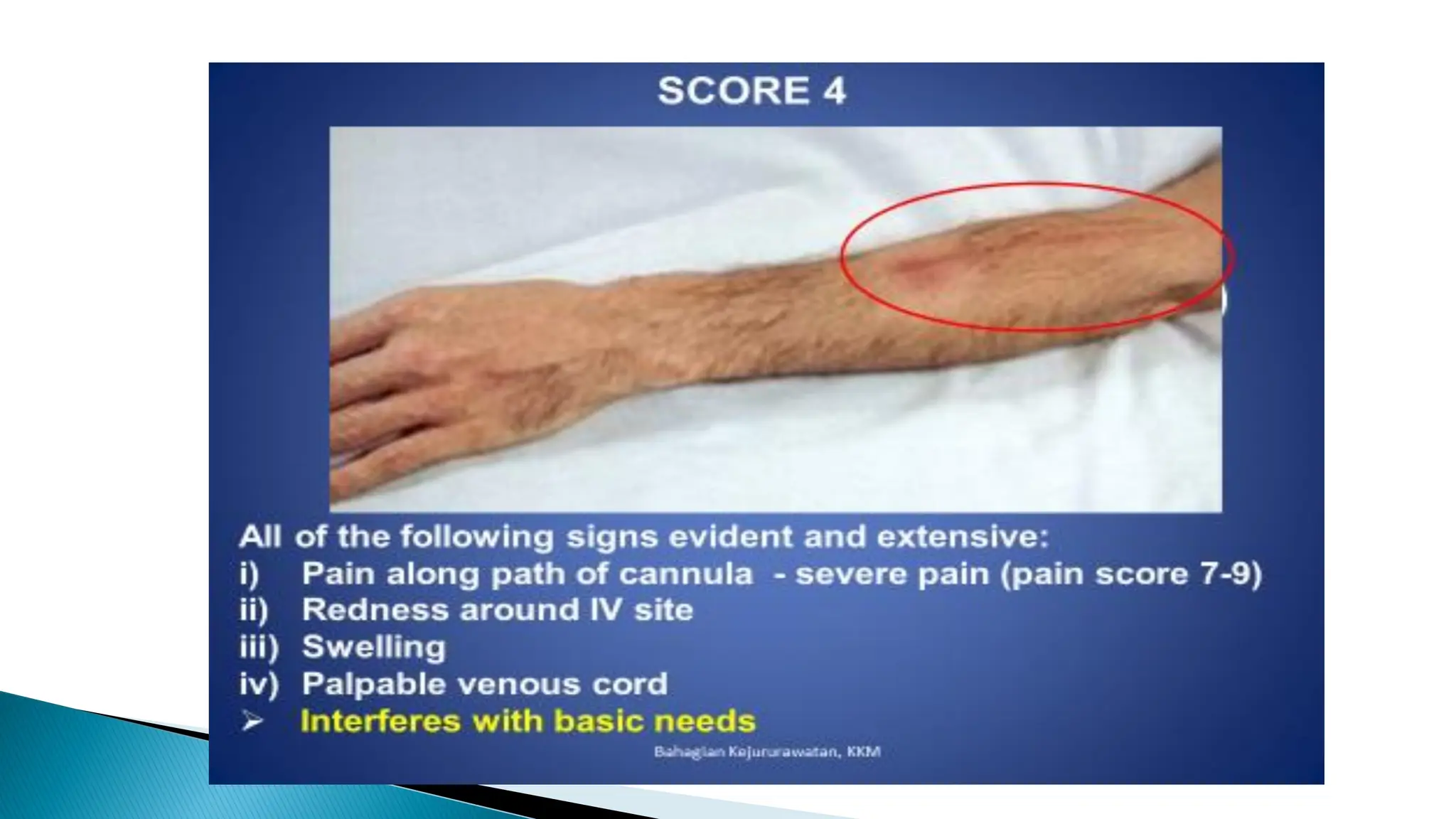 PHLEBITIS NEW INDICATOR FOR NURSES TEACHING SLIDE | PDF