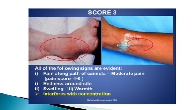 PHLEBITIS NEW INDICATOR FOR NURSES TEACHING SLIDE | PDF | Diseases and ...