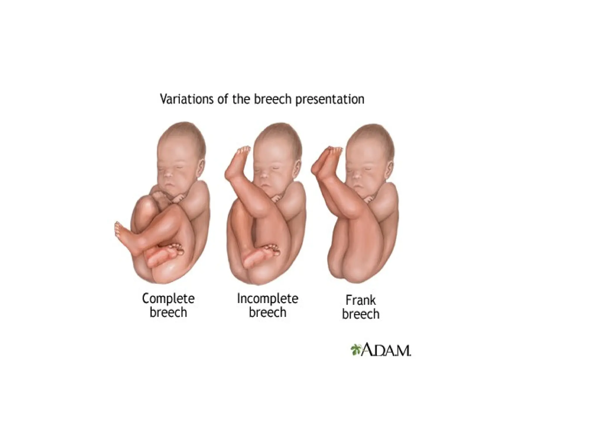 intranatal period during delivery ...... | PPTX