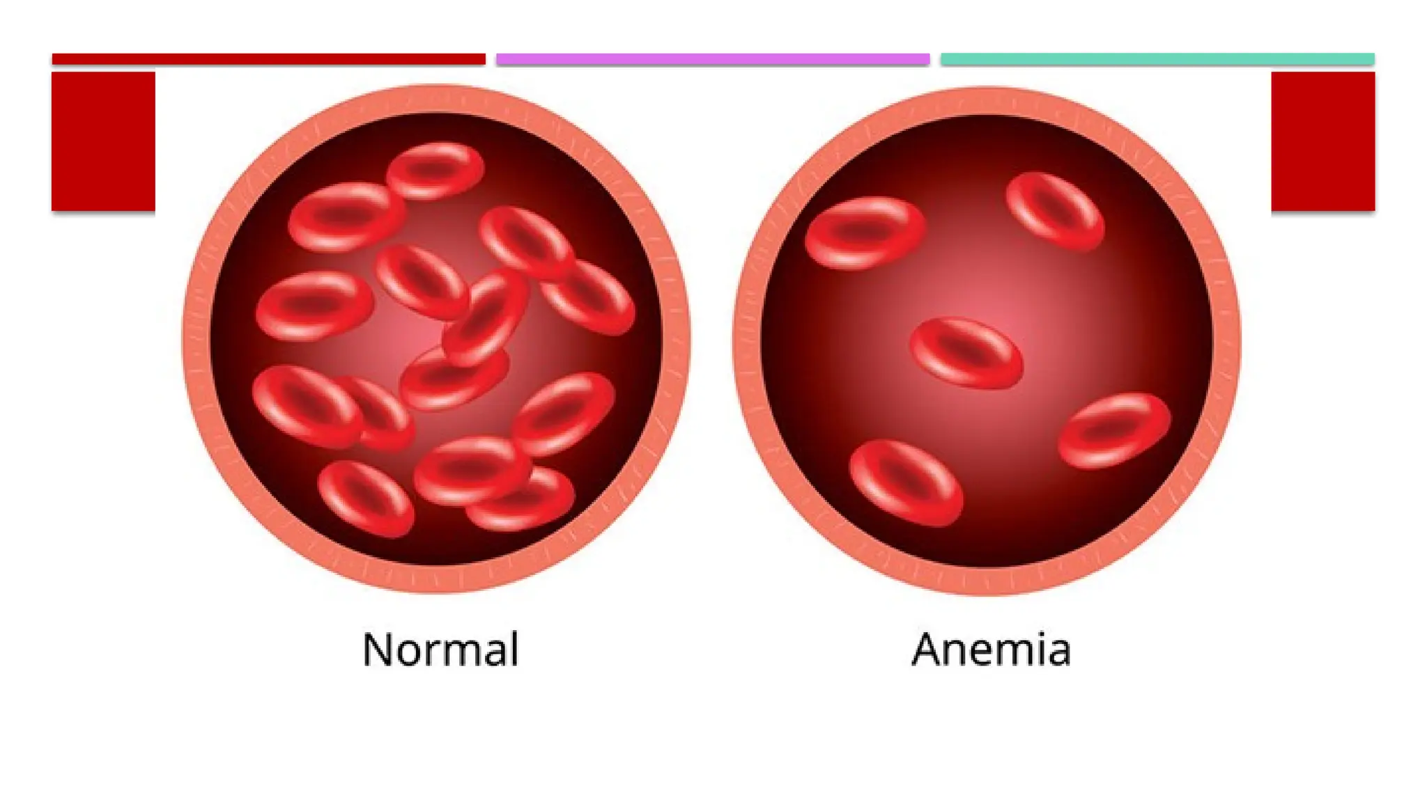 Fisiopatología y tratamiento de la anemia | PPTX