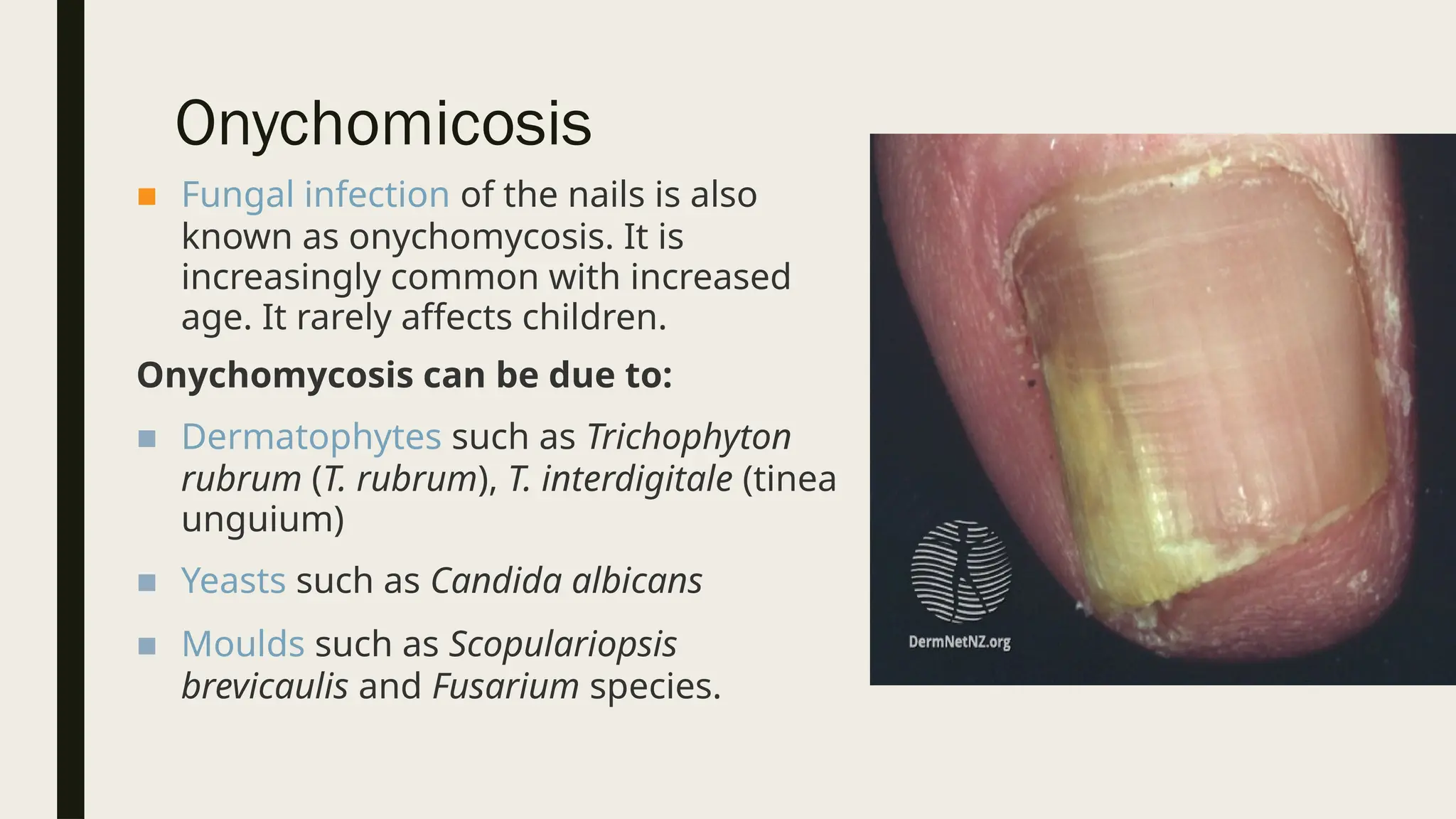 Mycology, tinea corporis, onychomycosis. | PPTX