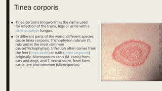 Mycology, tinea corporis, onychomycosis. | PPTX