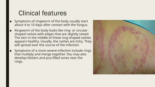 Mycology, tinea corporis, onychomycosis. | PPTX