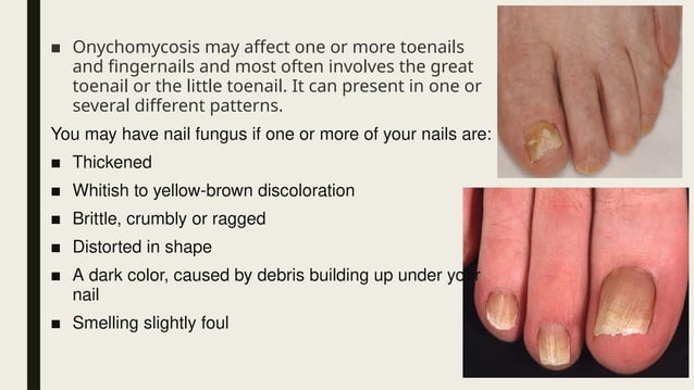 Mycology, tinea corporis, onychomycosis. | PPTX