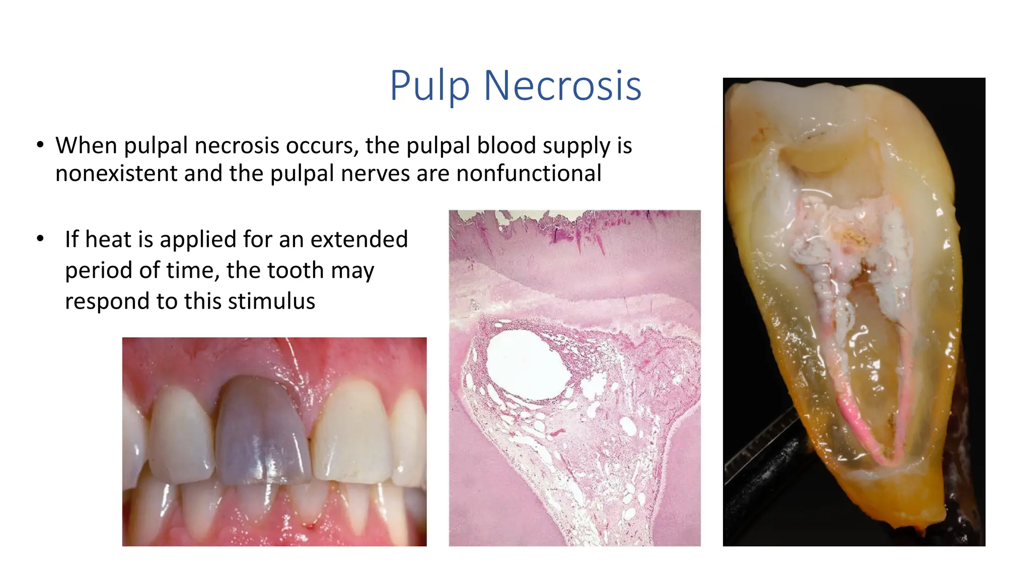2. pulpitis, DENTAL PULP, PULP CHARACTHERISTICS | PDF