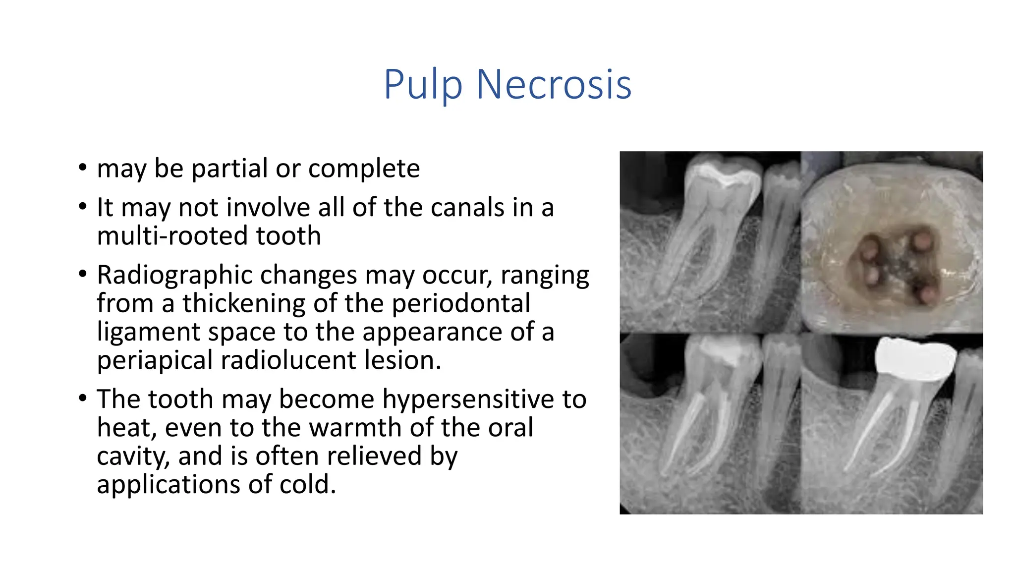 2. pulpitis, DENTAL PULP, PULP CHARACTHERISTICS | PDF