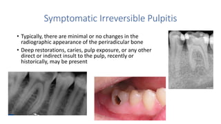 2. pulpitis, DENTAL PULP, PULP CHARACTHERISTICS | PDF