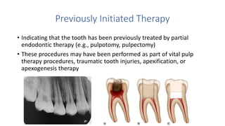 2. pulpitis, DENTAL PULP, PULP CHARACTHERISTICS | PDF