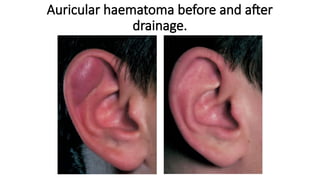 2. AURICULAR TRAUMA Auricular trauma.pptx