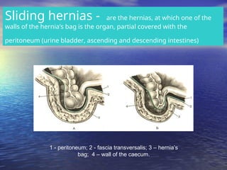 A hernia is the abnormal protrusion of an organ or tissue through a ...