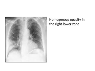 2. PNEUMONIA IN CHILDREN.pptx learning notes | PPT