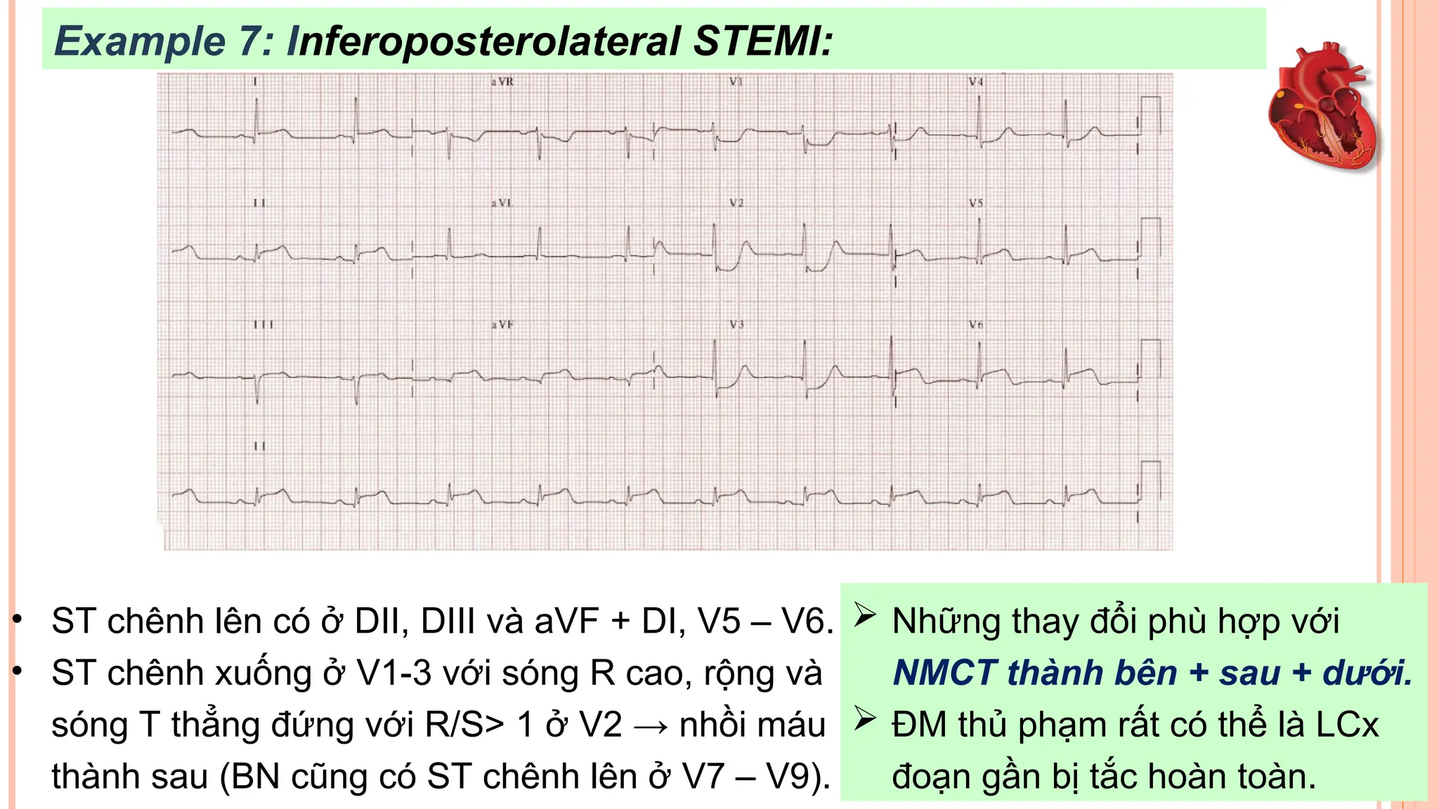 2. ECG STEMI 6-2021 trong nhoi mau co tim cap | PPT