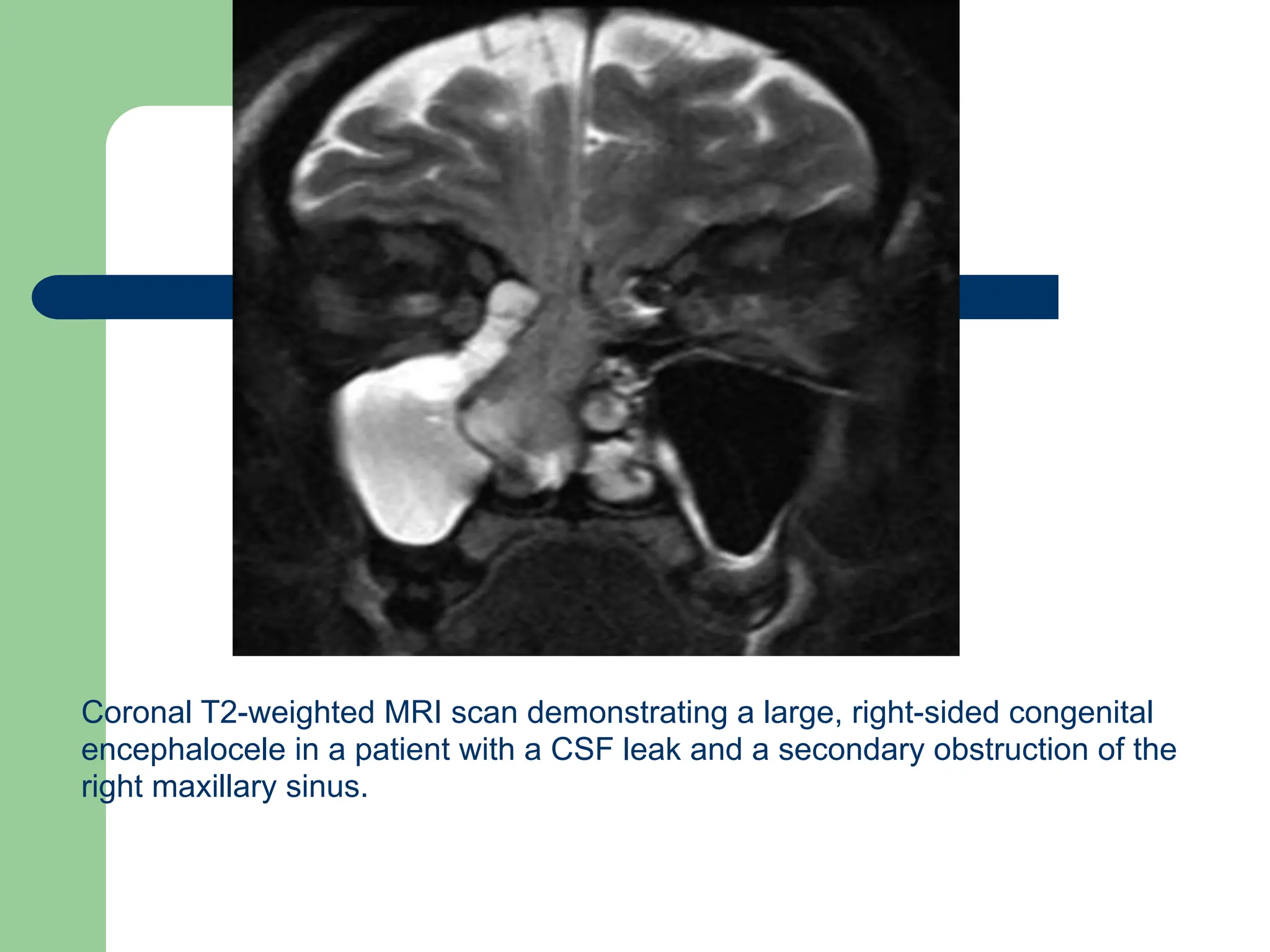 Cerebrospinal fluid Rhinorrhea by dr avan | PDF