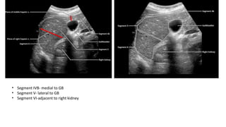 2.1 USG abdomen -LIVER anatomy and scanning techniques.ppt by ajit | PPTX