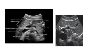 2.1 USG abdomen -LIVER anatomy and scanning techniques.ppt by ajit | PPTX