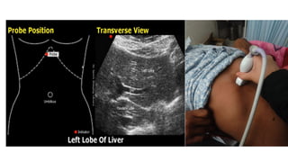 2.1 USG abdomen -LIVER anatomy and scanning techniques.ppt by ajit | PPTX