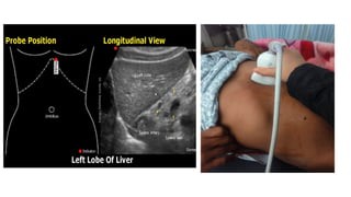2.1 USG abdomen -LIVER anatomy and scanning techniques.ppt by ajit | PPTX