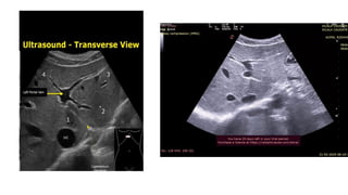 2.1 USG abdomen -LIVER anatomy and scanning techniques.ppt by ajit | PPTX