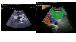 2.1 USG abdomen -LIVER anatomy and scanning techniques.ppt by ajit | PPTX