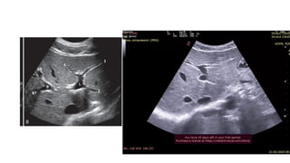 2.1 USG abdomen -LIVER anatomy and scanning techniques.ppt by ajit | PPTX