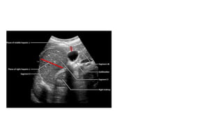 2.1 USG abdomen -LIVER anatomy and scanning techniques.ppt by ajit | PPTX
