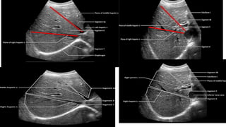 2.1 USG abdomen -LIVER anatomy and scanning techniques.ppt by ajit | PPTX