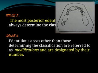 2. kennedys classification IN RPD DENTURE.pptx