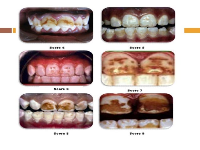indices measuring dental fluorosis