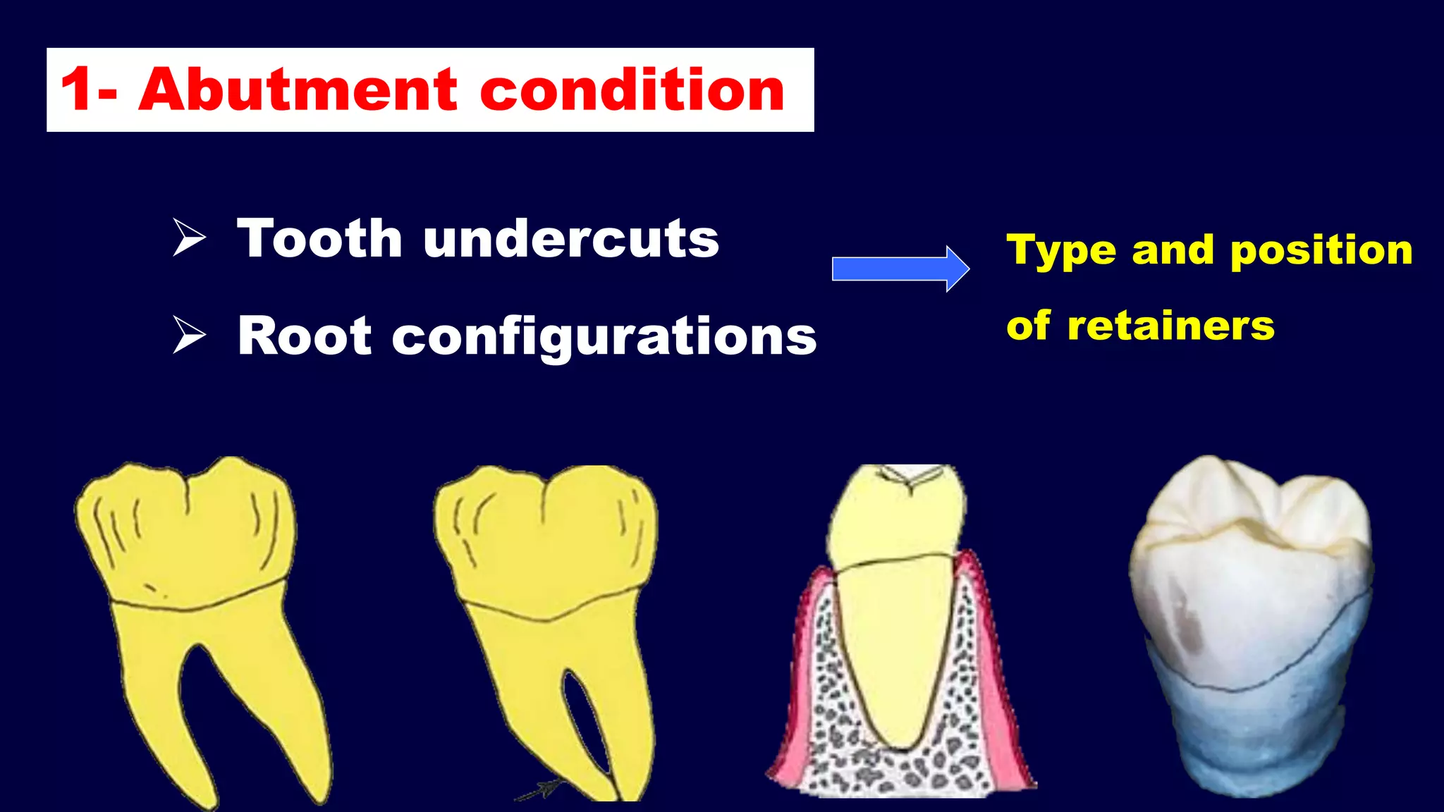 2- a. Basic principles for designing the removable partial denture ...