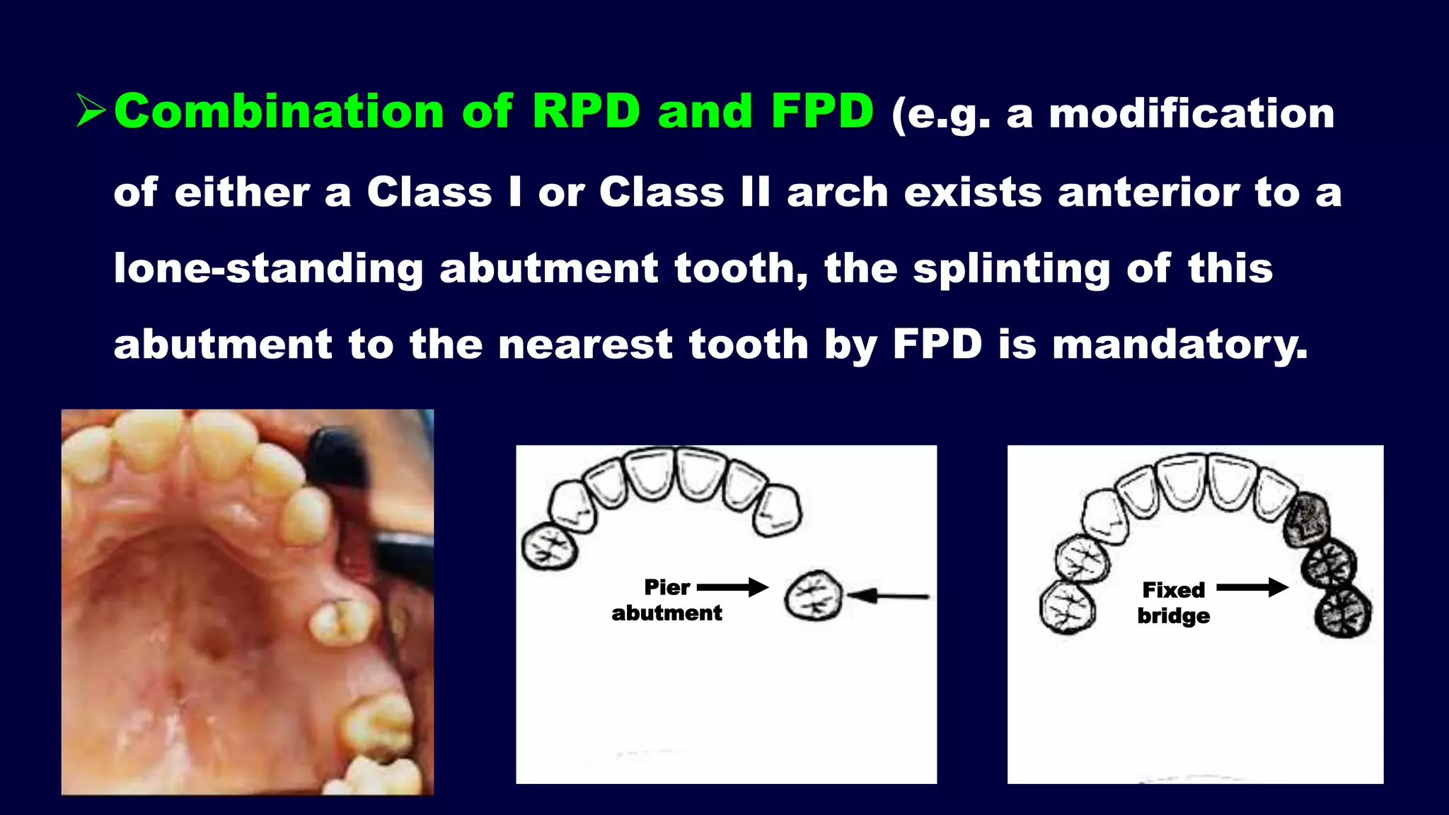 2- a. Basic principles for designing the removable partial denture ...