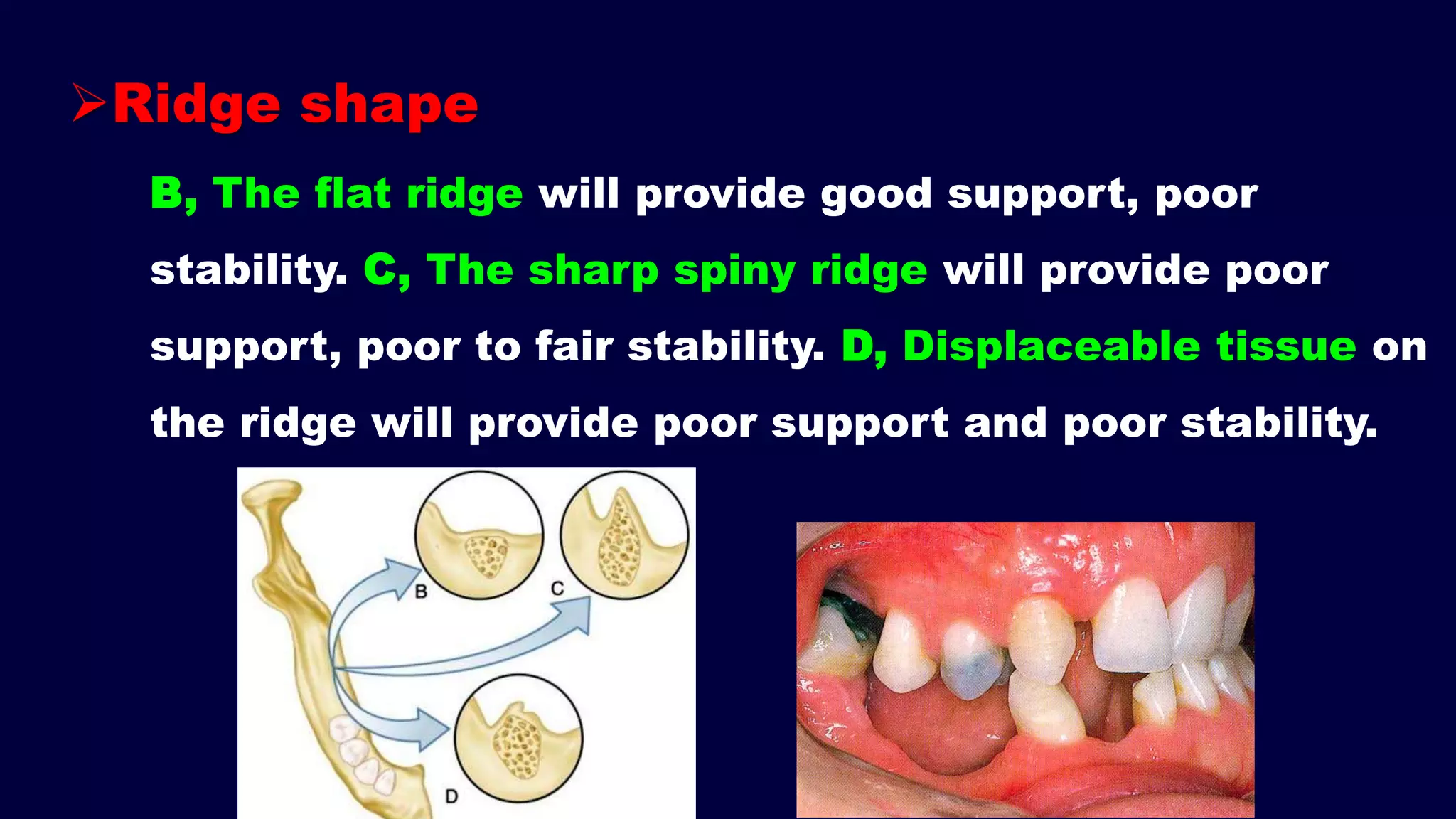2- a. Basic principles for designing the removable partial denture ...