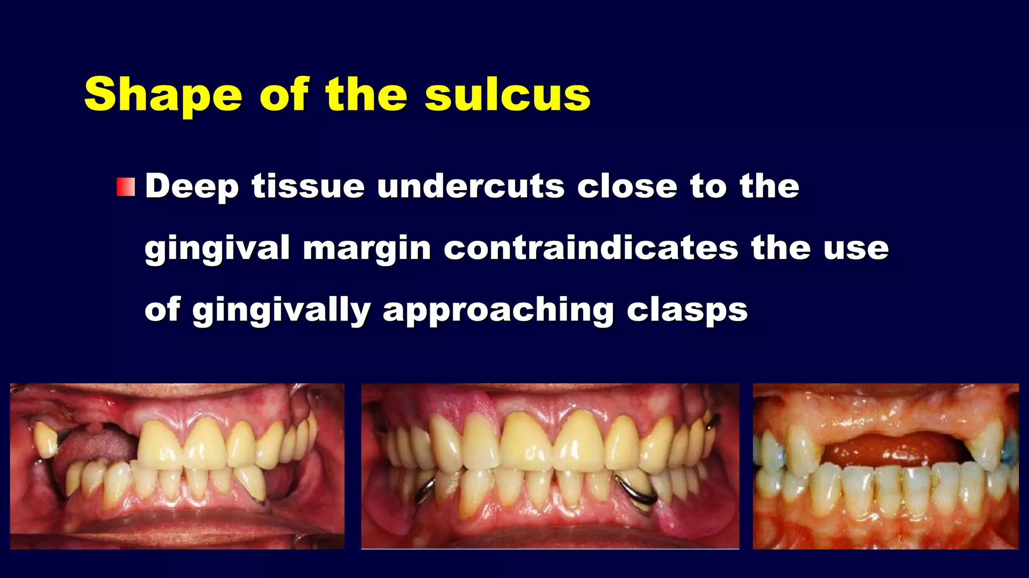 2- a. Basic principles for designing the removable partial denture ...