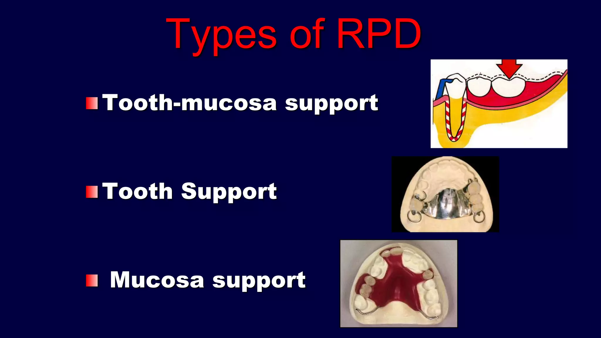 2- a. Basic principles for designing the removable partial denture ...