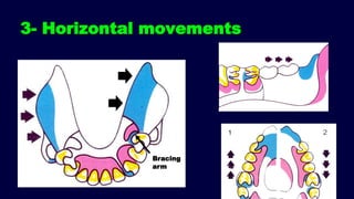 2- a. Basic principles for designing the removable partial denture (class I partial denture ...