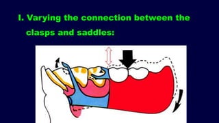 2- a. Basic principles for designing the removable partial denture ...