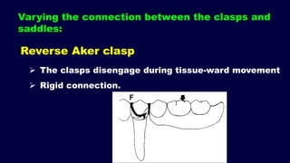 2- a. Basic principles for designing the removable partial denture ...