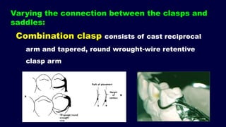2- a. Basic principles for designing the removable partial denture ...