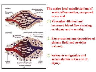 acute inflammation | PPT